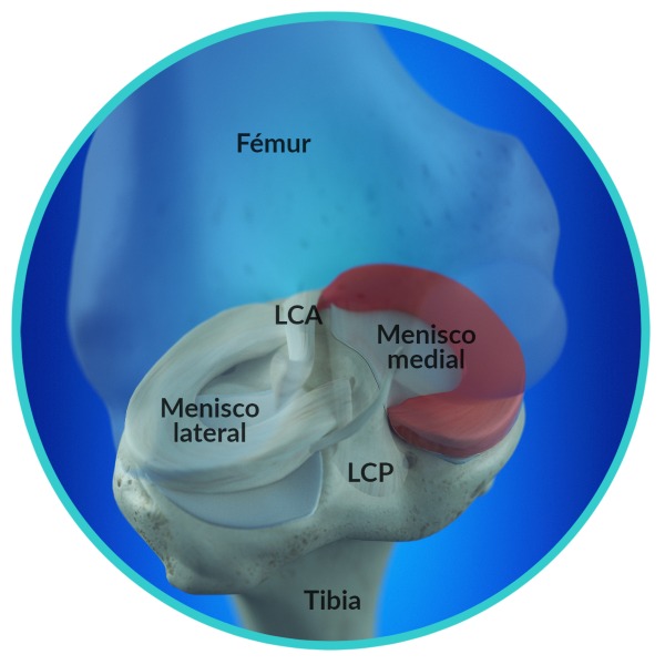 Los meniscos – Dra Cristina Ramos